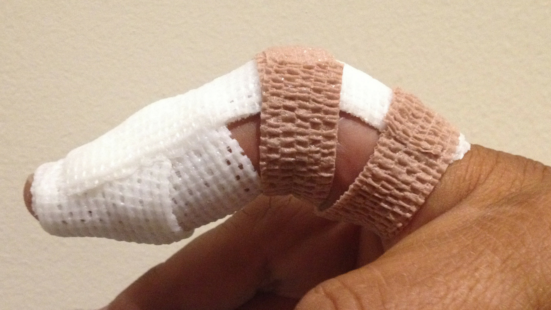 Common Upper Limb Conditions | Action Rehab Hand Therapy
