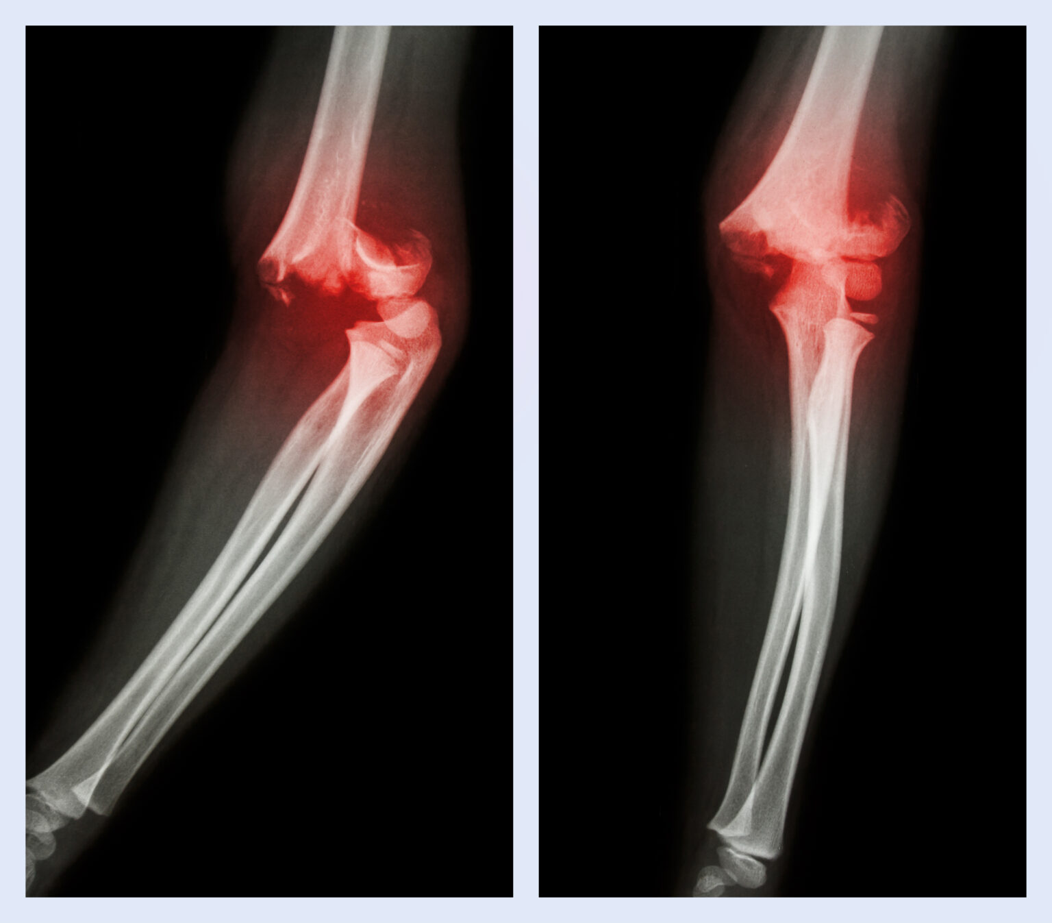Dislocated Elbow Treatment Brisbane