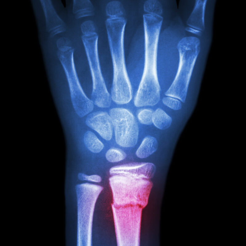 Greenstick Fracture or Paediatric Fracture Treatment